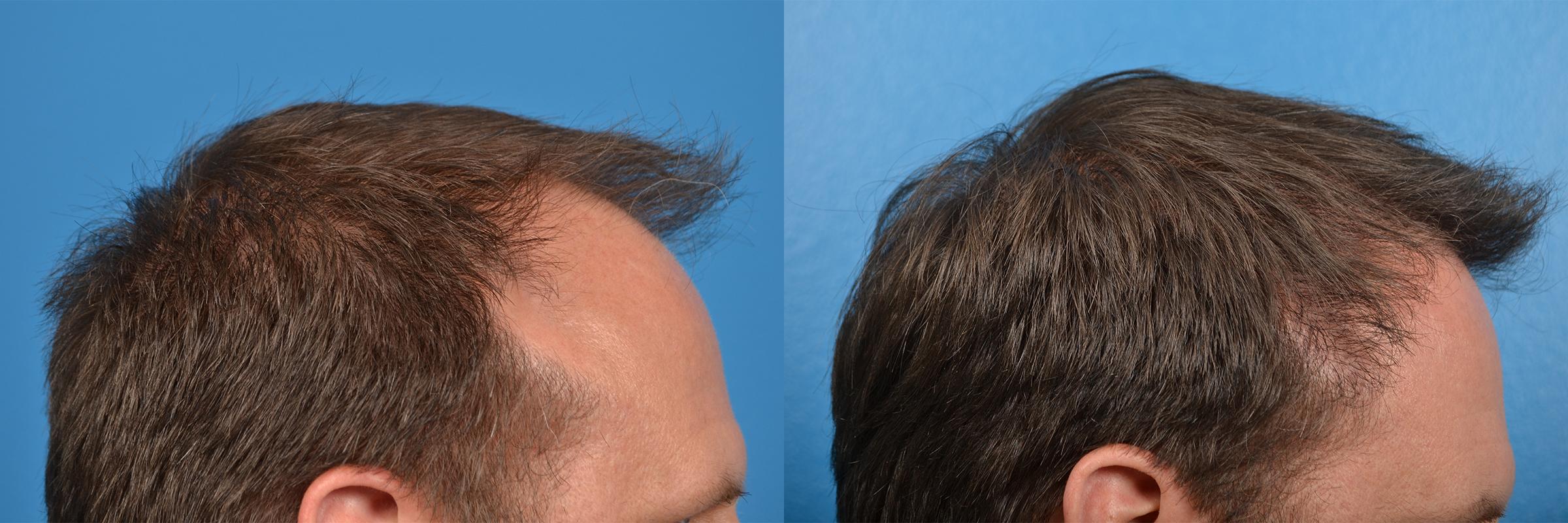 Hair Restoration Photos Melbourne Fl Patient 57533